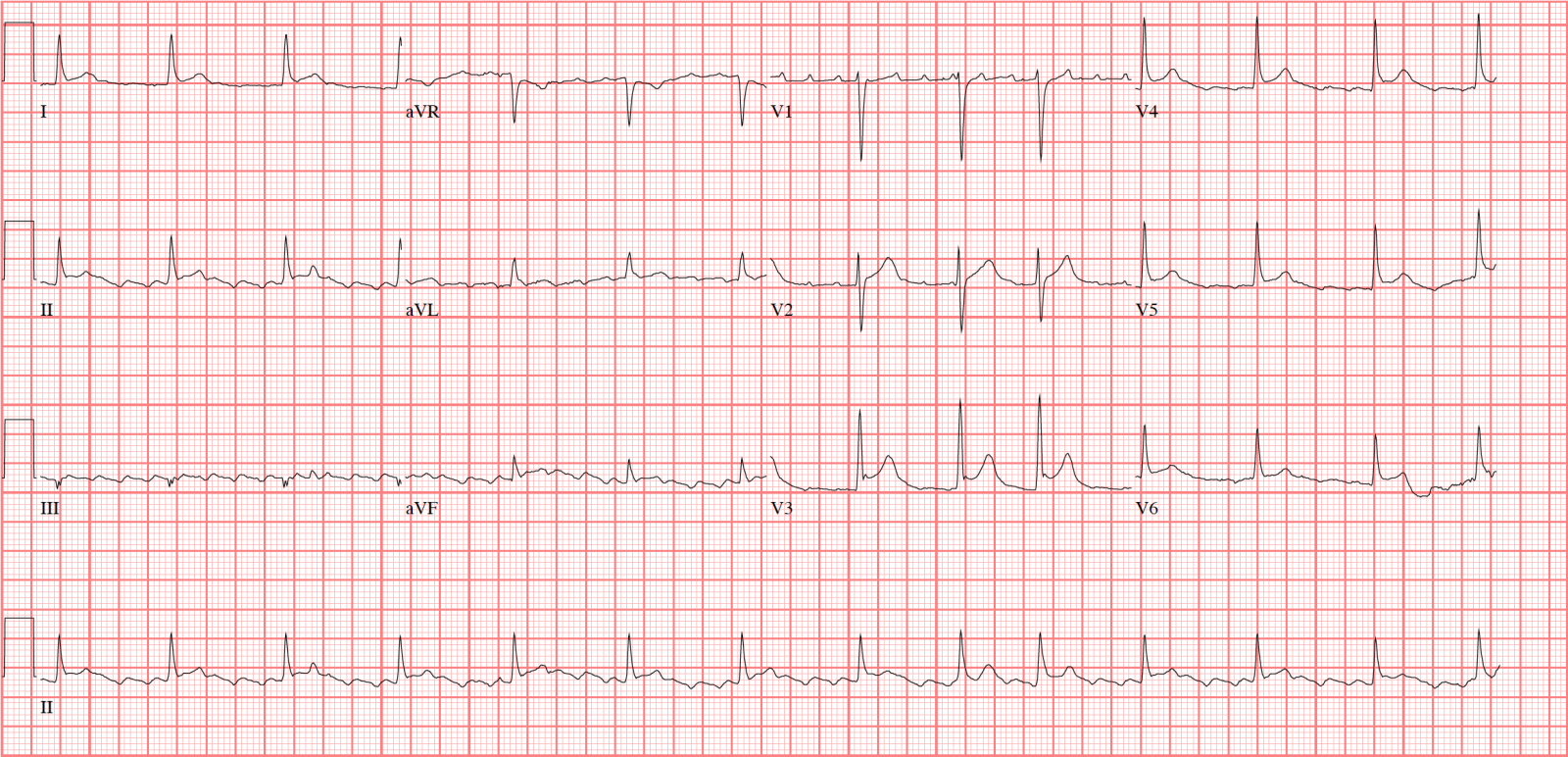 How To Calculate Atrial Rate In Atrial Flutter The Inducing Beats May